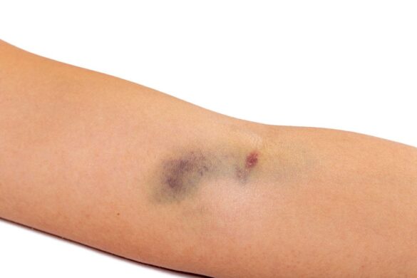 Blood Draw Archives - Practical Tips